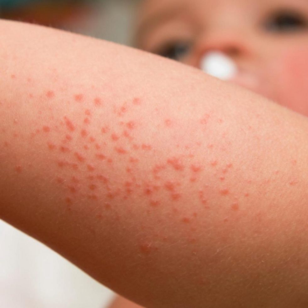 Dermatite Atópica - Dr Marcos Alergologista