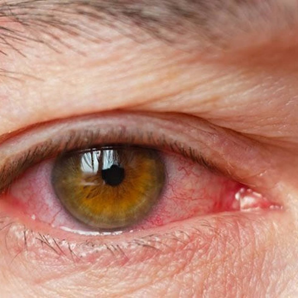 Conjutivite Alérgica - Dr Marcos Alergologista