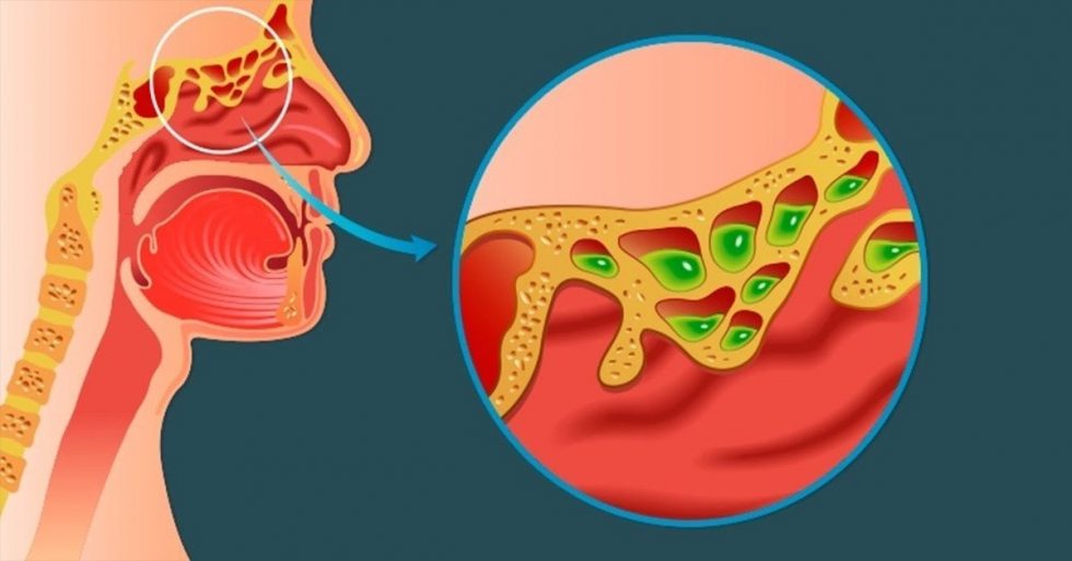 Rinite Alérgica - Dr Marco Alergologista